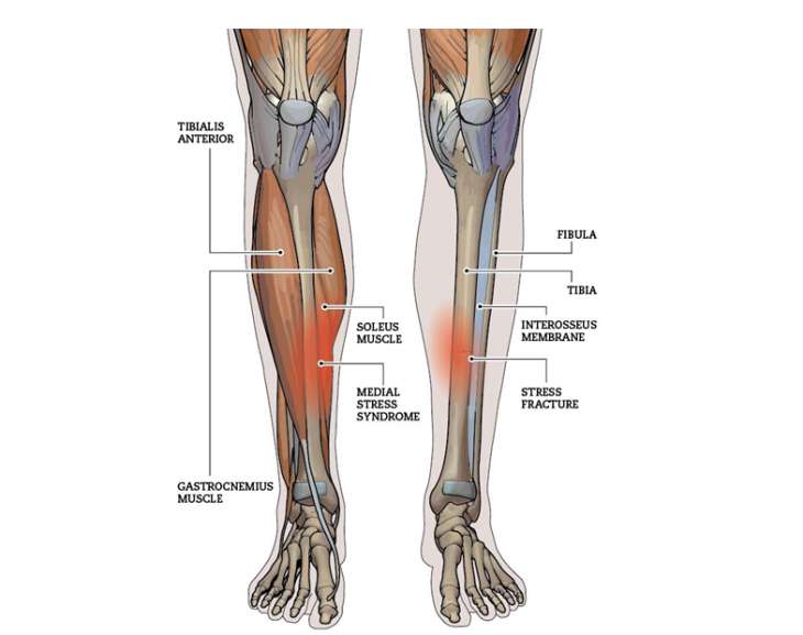 Exertional Shin Pain Or Shin Splints 
